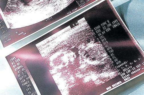 Red degeneration in pregnancy - All Woman