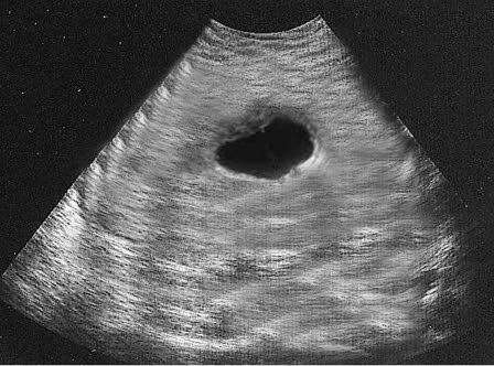 Blighted ovum — when the ultrasound shows no baby - All Woman