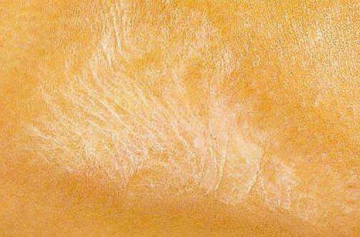 Scarring: A common skin problem - Jamaica Observer