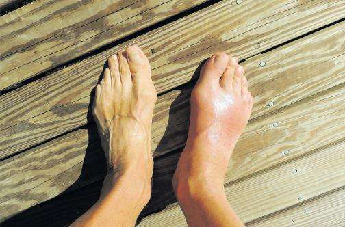Gout: Symptoms and treatment - Jamaica Observer