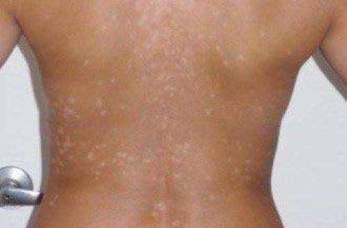 'Liver spots' - Jamaica Observer