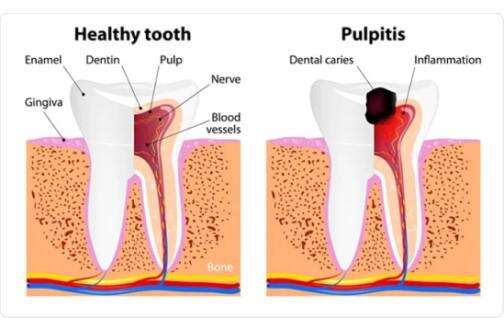What is pulp polyp? - Jamaica Observer