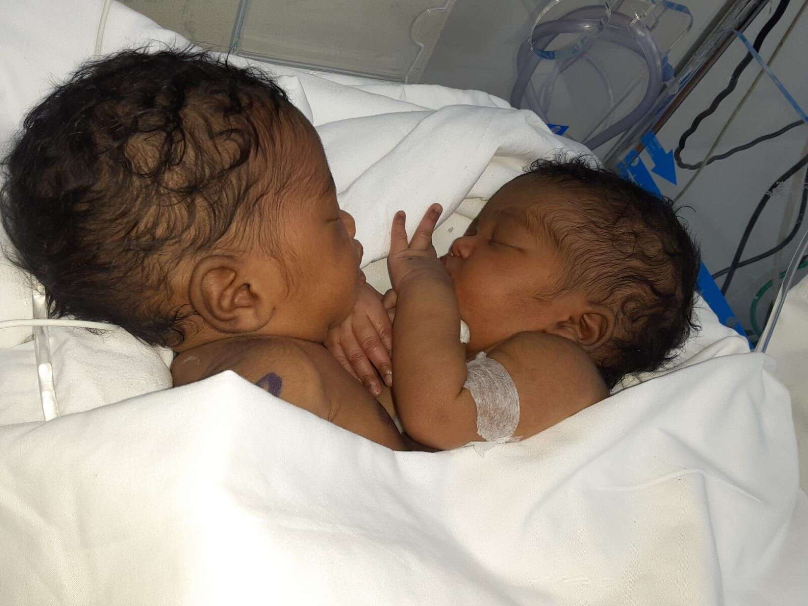 Mother of conjoined twins hoping for the best - Jamaica Observer