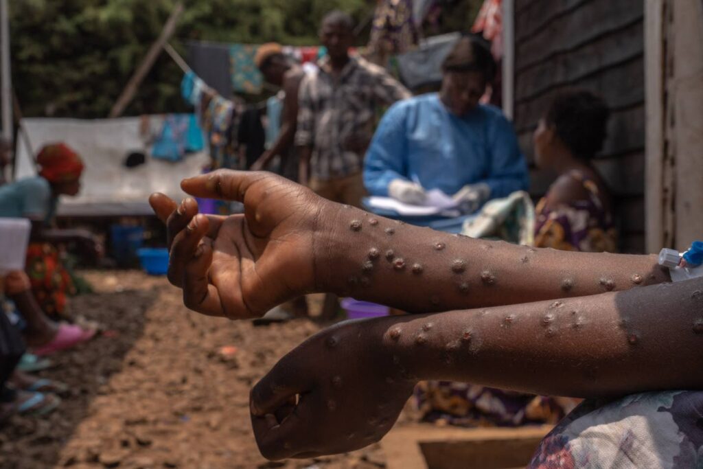 PAHO urges Caribbean countries to maintain Mpox surveillance, genomic ...