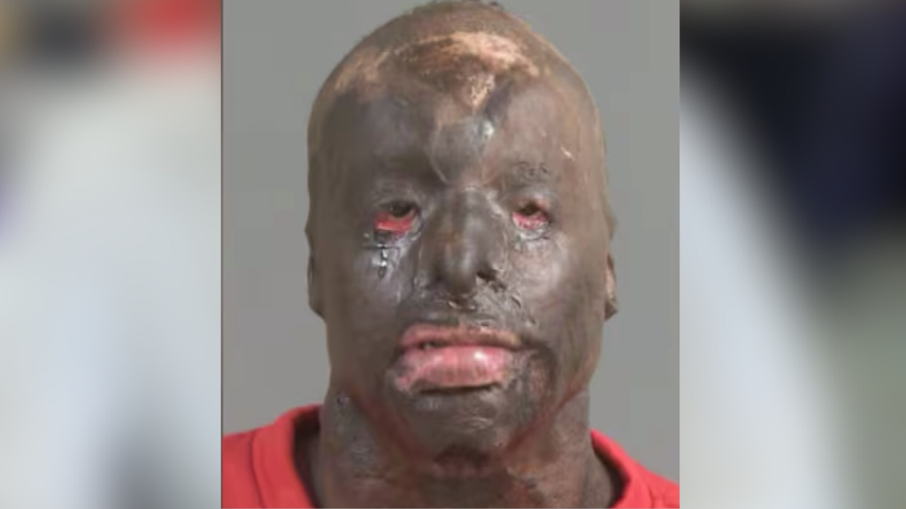 ‘These hands can’t pull a trigger’: Burn victim denies murder ...