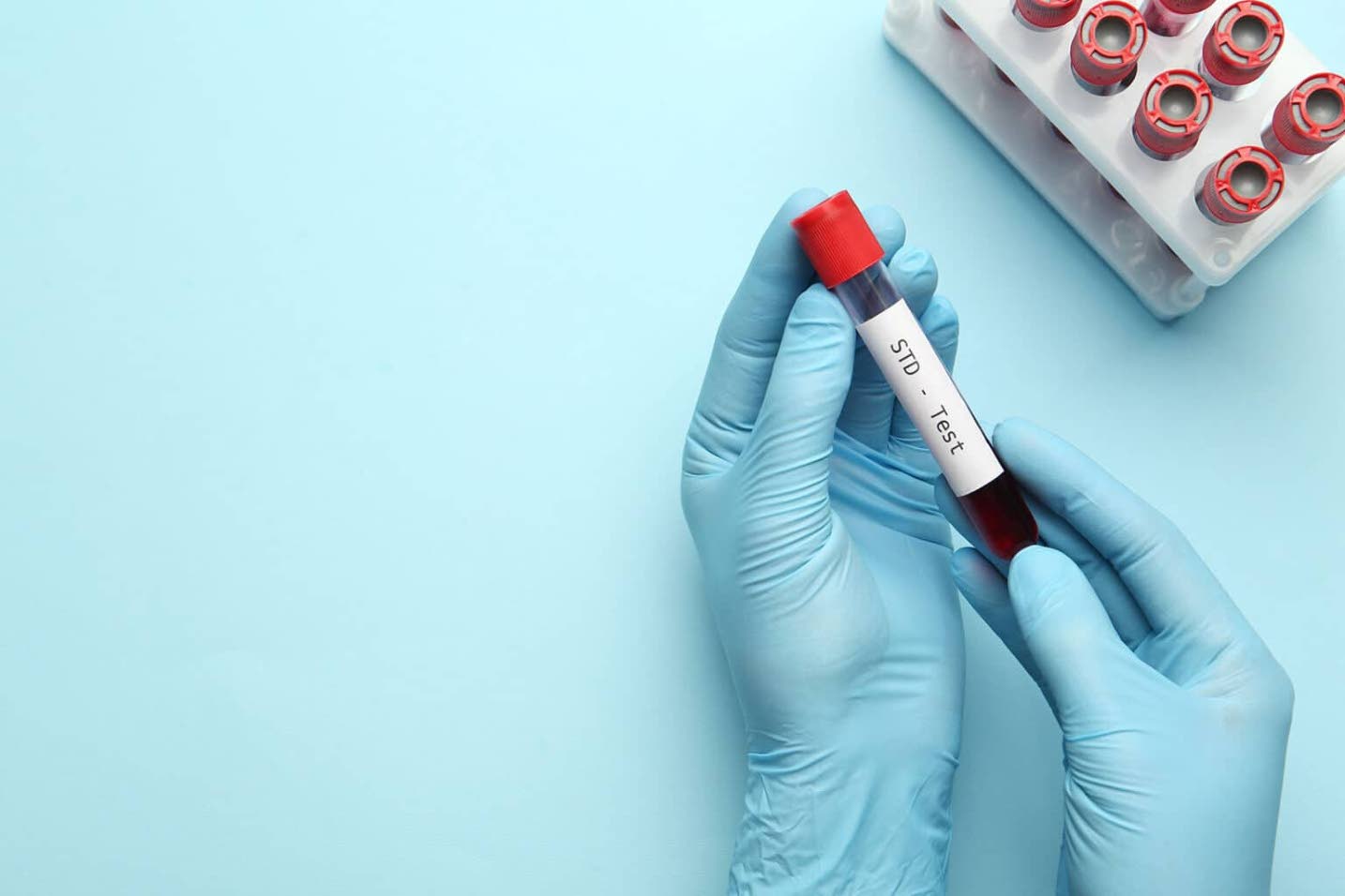 STI cases rise, highest rates among young adults - Jamaica Observer